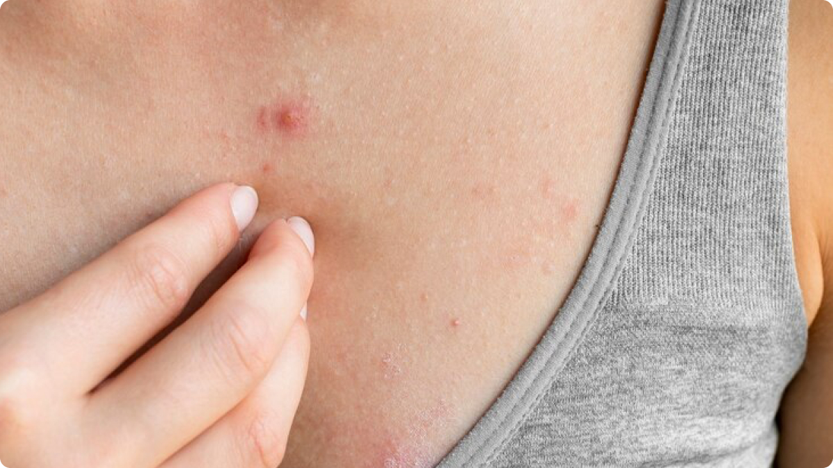 Como acabar de vez com as espinhas inflamadas: Dicas infalíveis! - Viva ...